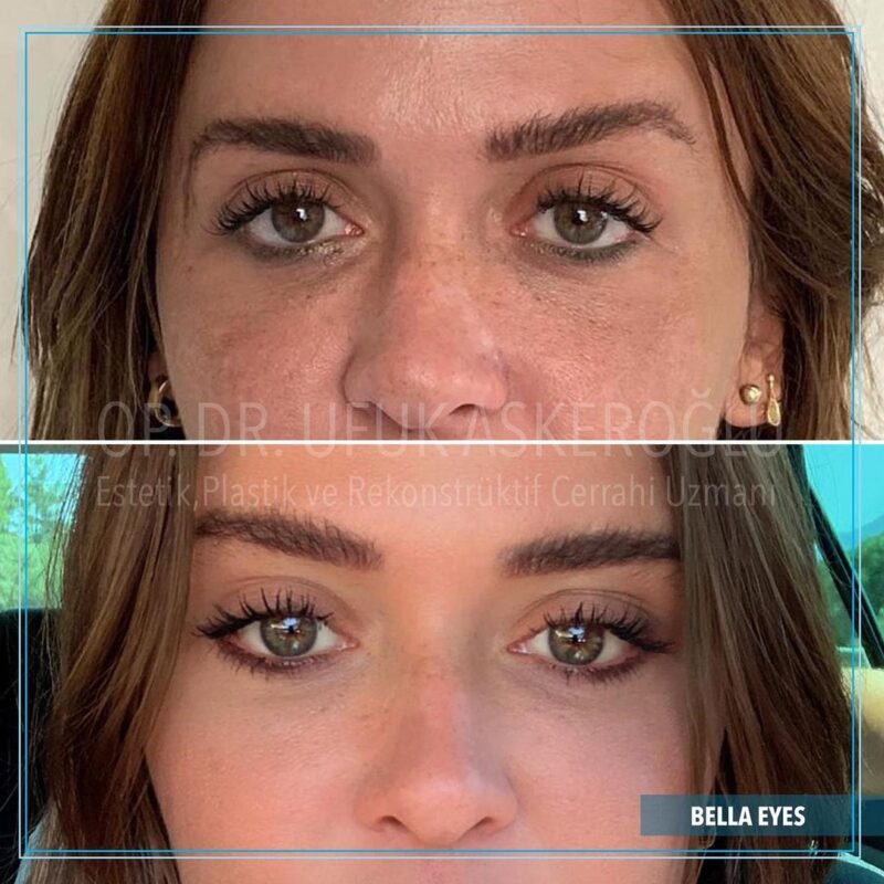 Bella Eyes Trinity Lift - Bella Eyes